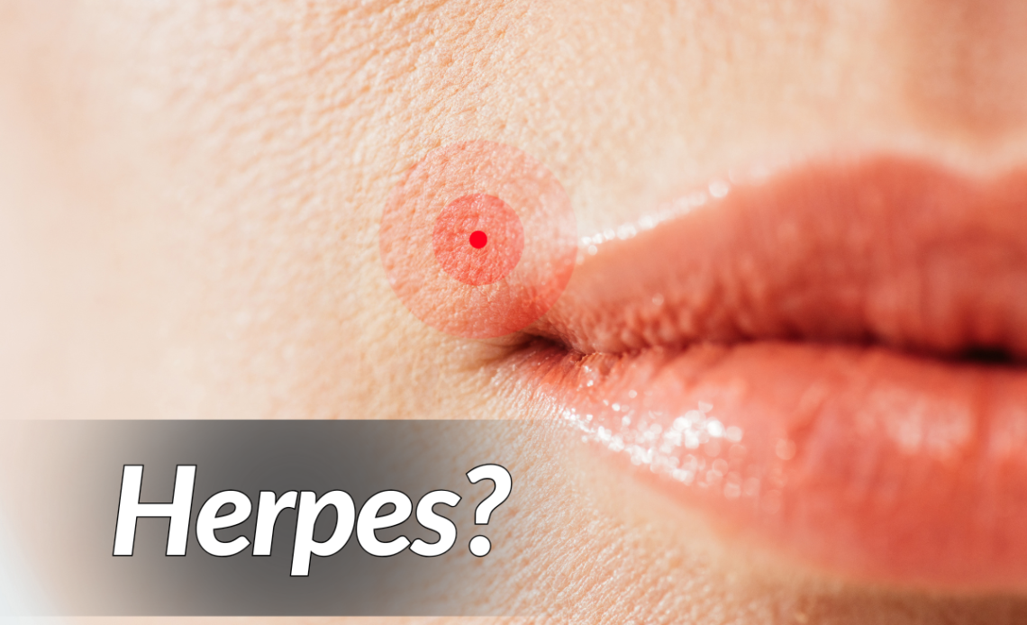 The Truth About Herpes: Shattering Myths and Finding the Right Treatment